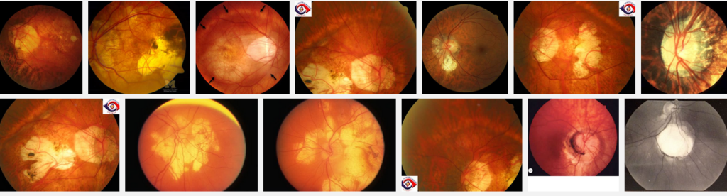 Images of different eye pathologies | Hawaii On Line University Bible College